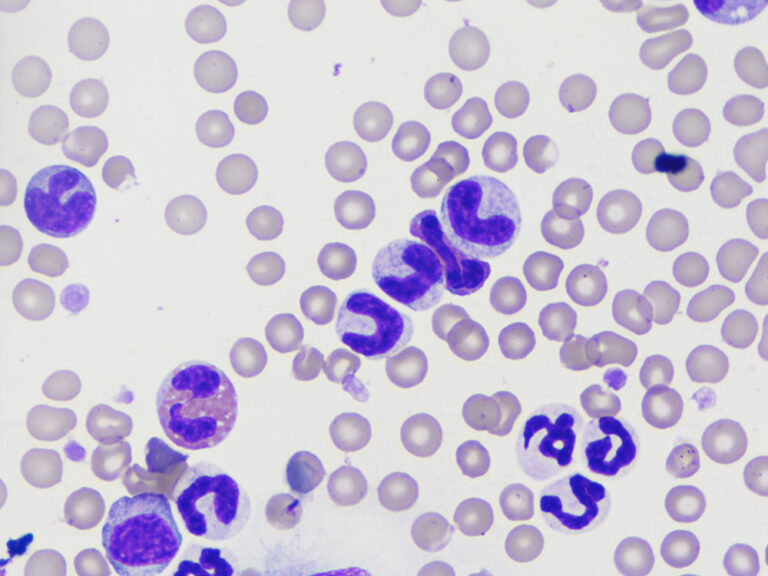 Diagnostic testing in cases of leukocytosis