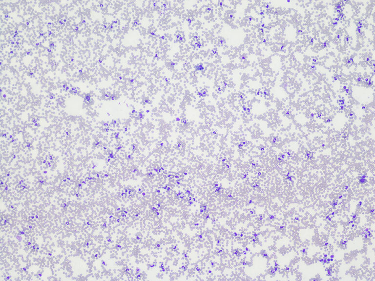 Diagnostic testing in cases of leukocytosis