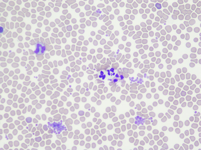 Diagnostic testing in cases of leukocytosis
