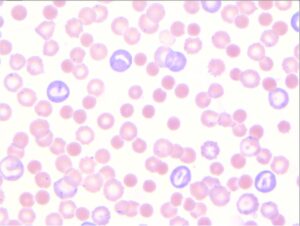 Which tests can help me diagnose an immune-mediated hemolytic anemia ...