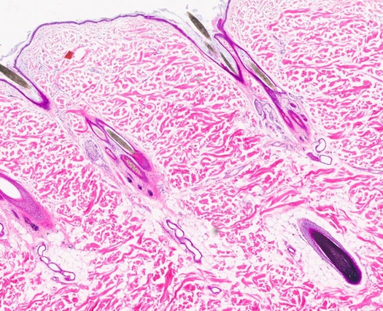 Colour Dilution Alopecia/CDA
