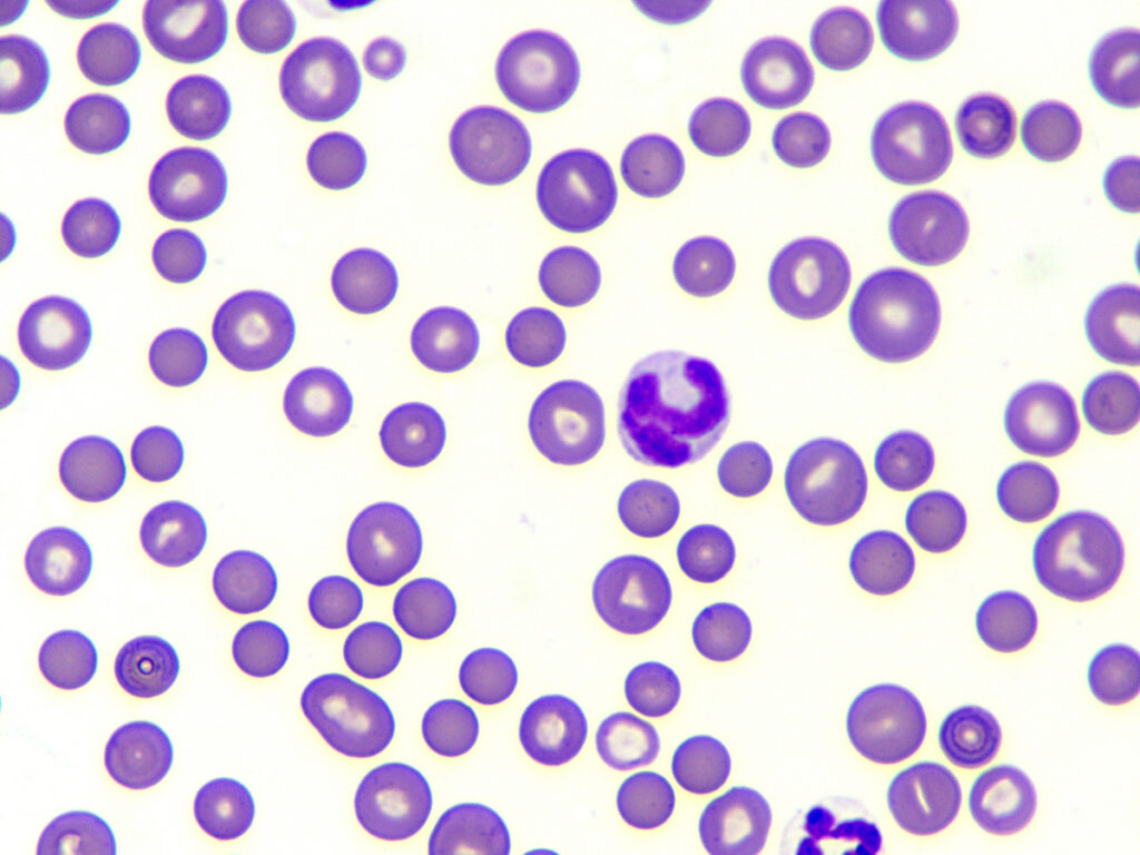 Expert round table on immune haemolytic anaemia (IMHA)